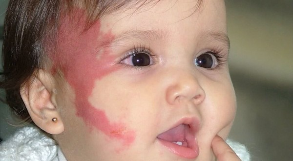 Angioma en Niños; Qué es, Síntomas y Tratamiento ️