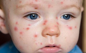Granos en la Cara en Bebés y Niños ⇒ 【Tratamiento】 ️