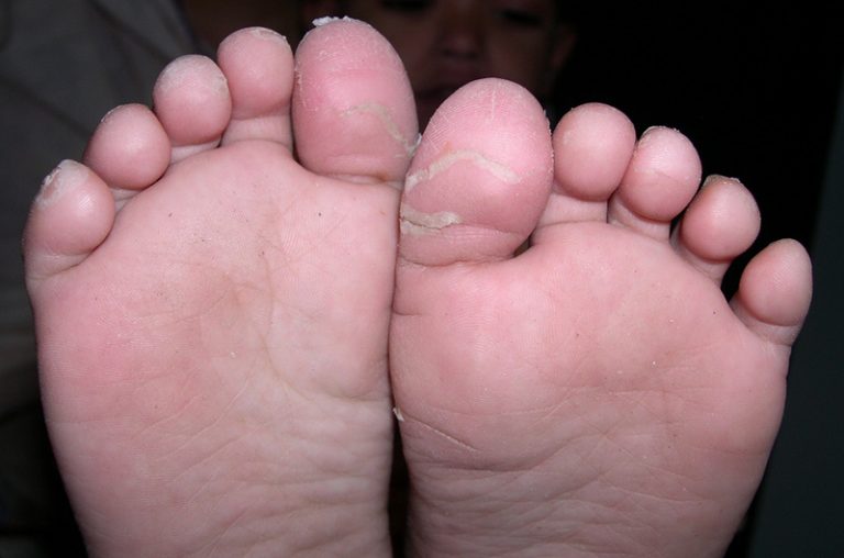Cómo Curar la Dermatitis Plantar Juvenil ⇒ 【Guía】 ️